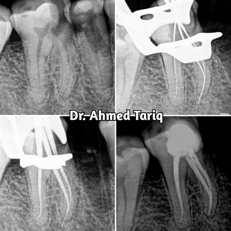 Ahmed Tariq On Linkedin Dentistry Endodontics Rootcanaltreatment