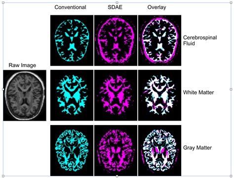 What Is Brain Segmentation At Janie Ware Blog