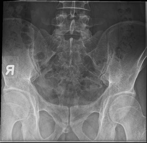 What Is Lumbar And Sacroiliac Radiography At Jasmine Hardee Blog