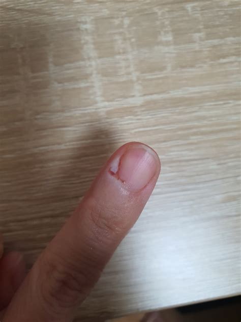 상처 났을 때 빨리 낫는 법 네이버 블로그