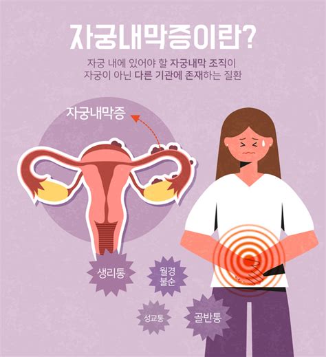 자궁내막증 맞춤형 표적치료 가능해진다 네이트 뉴스