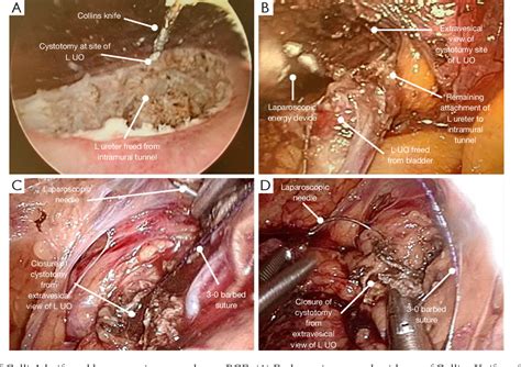 Figure 4 From Controversies In Management Of The Bladder Cuff At