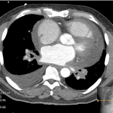 Mri Cardiac Morphology W And W O Contrast T1 T2 Parametric Mapping Download Scientific