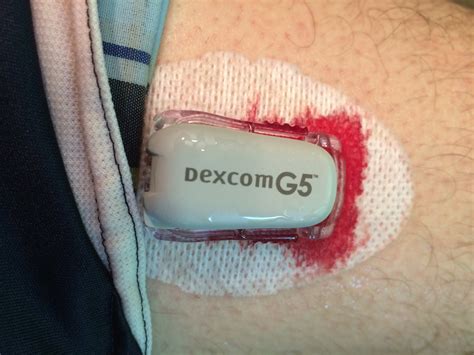Dexcom Fail C GM FUDiabetes