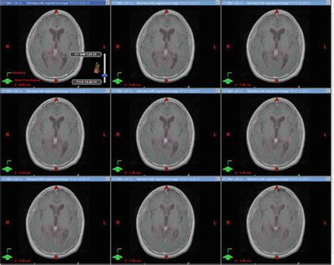Brain Tumors Radiology Key