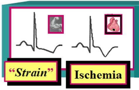 T Wave Inversion Ischemia