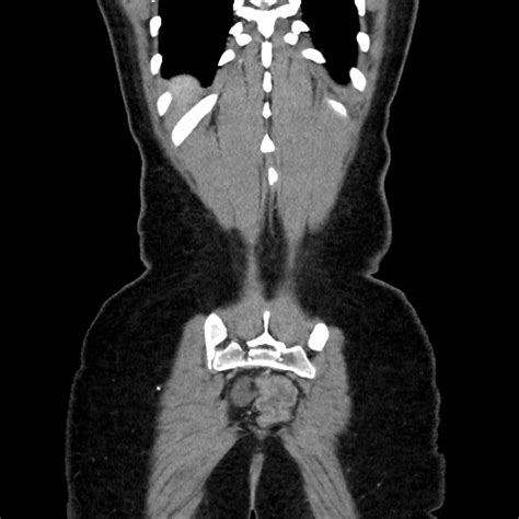 File Crohns Disease Terminal Ileitis Fistulizing Radiopaedia 98245