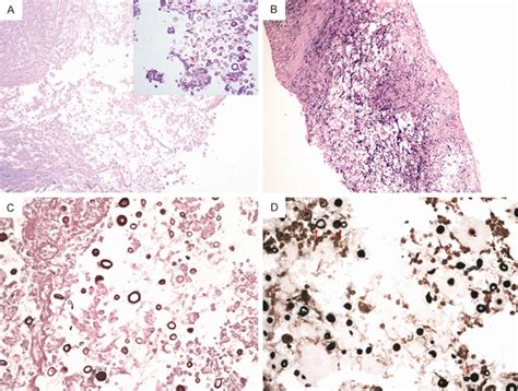 Clinicopathological Features Of Pulmonary Cryptococcosis With