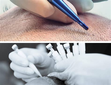Hybrid Hair Transplant Westmodern Clinic