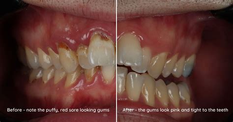 What Does Gum Disease Look Like The Signs Symptoms