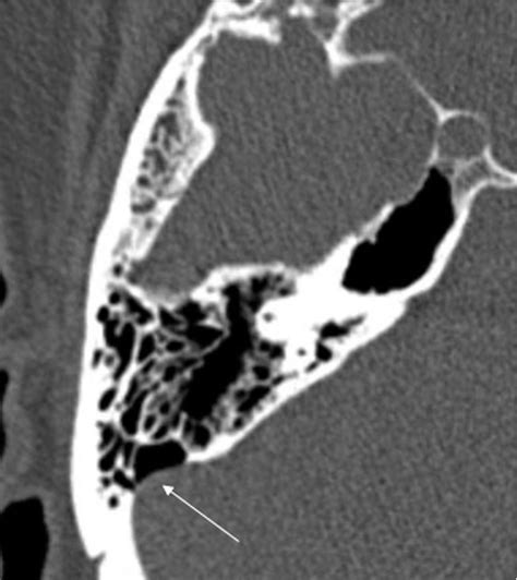 Figure 1 From Prevalence Of Sigmoid Sinus Dehiscence And Diverticulum Among Adults With Skull