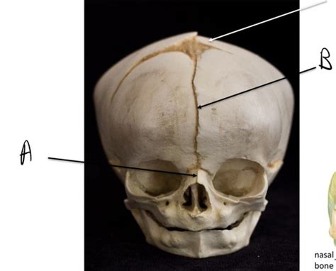 Development Of Bone And Skull Sex Differences Flashcards Quizlet