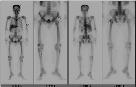 Whole Body Bone Scan Shows Increased Technetium Uptake On Left Ilium Download Scientific
