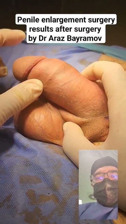 Penile Enlargement Surgery Results After Surgery By Dr Araz Bayramov