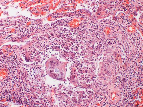 Cryptococcosis A Granuloma With Containing Several Fungal … Flickr