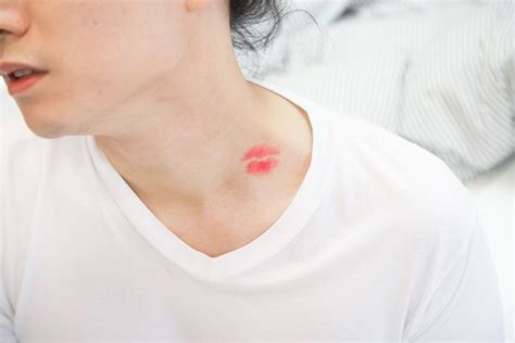 How To Get Rid Of A Hickey Facty
