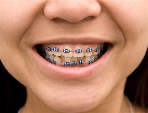 Interproximal Reduction IPR High Line Orthodontics