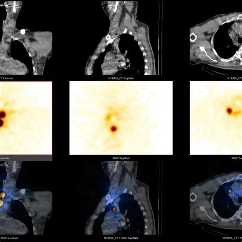 131 I Post Ablation Hybrid Spectlow Dose Ct Images Demonstrating Neck