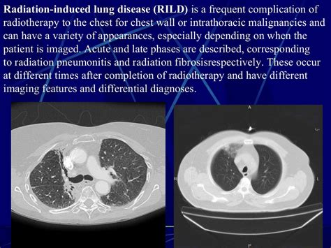 Hrct Reticular Pattern