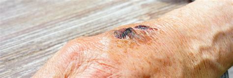 What Are Scabs Elastoplast