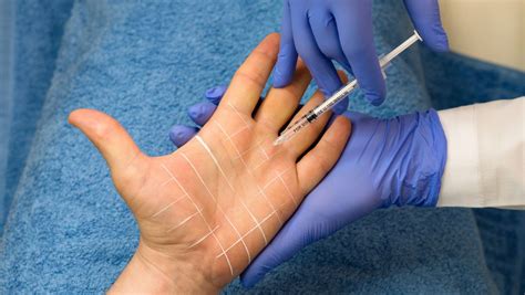 Novel Ways Of Using Botulinum Toxin To Improve Both Appearance And Self