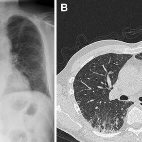 A Chest X Ray With Diffuse Bilateral Interstitial Pattern B Download Scientific Diagram