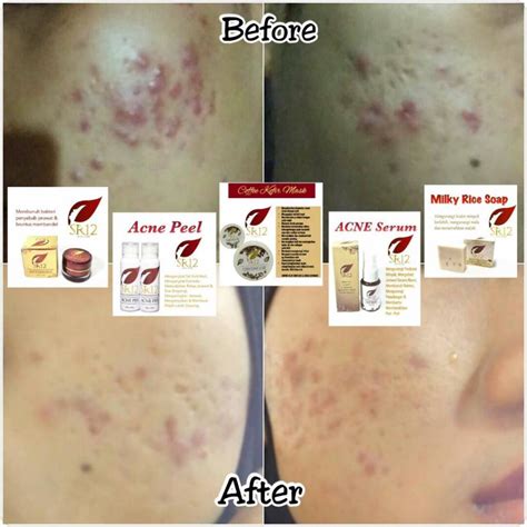 Testimoni Sr12 Skin Care