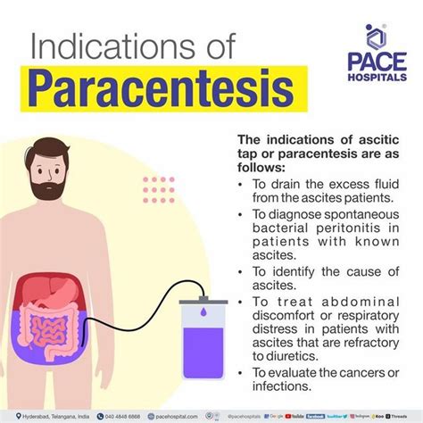 Paracentesis Position Paracentesis Procedure