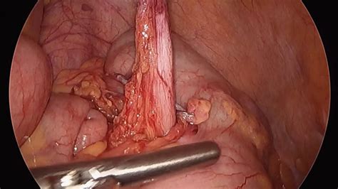 Retrocecal Appendix Youtube