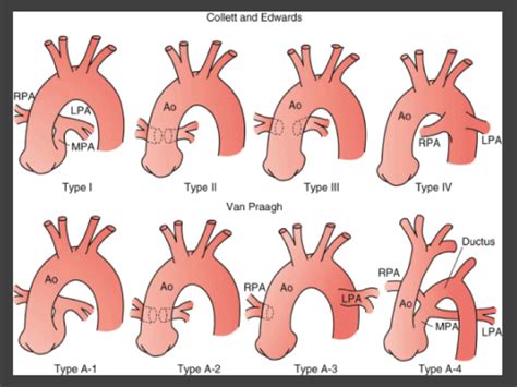Truncus Arteriosus Types