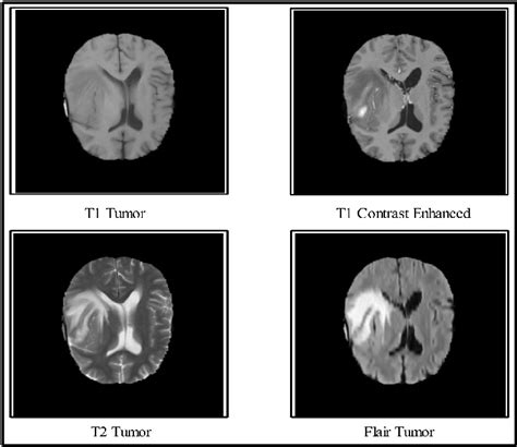 Figure 1 From Multimodal Brain Tumor Classification Using Deep Learning