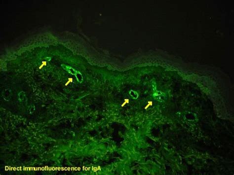 Difference Between Direct And Indirect Immunofluorescence
