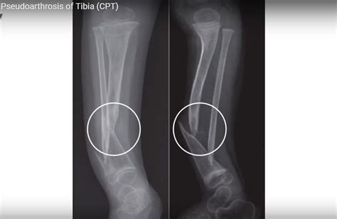 Congenital Pseudoarthrosis Of Tibia —