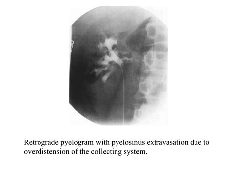Retrograde Pyelography