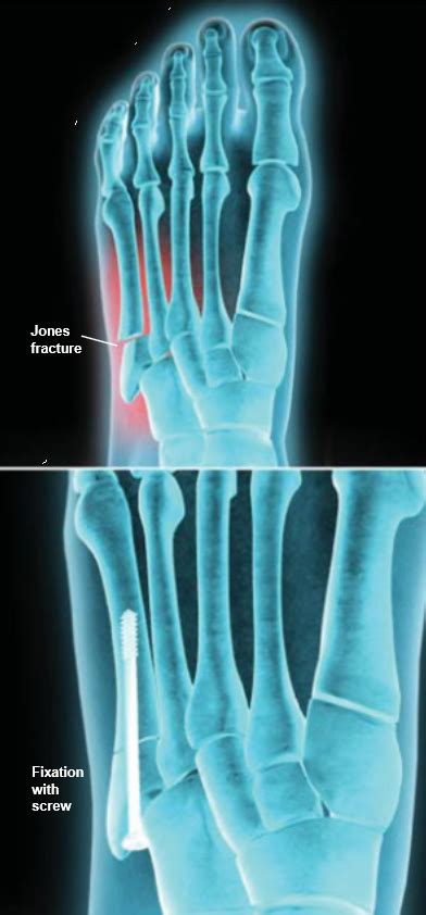 Jones Fracture Fixation Central Coast Orthopedic Medical Group