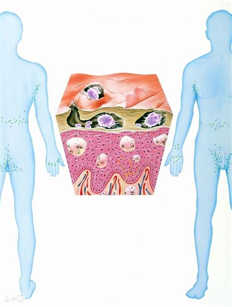 得疥瘡奇癢難忍怎麼辦？不用愁，在廚房有樣東西能治好它！ 每日頭條