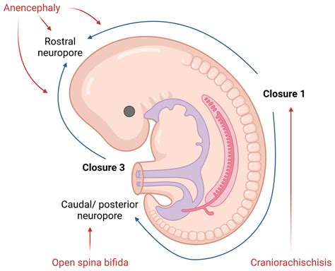 Neural Tube Defects Encyclopedia Mdpi