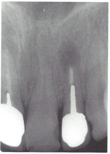 Surgical Endodontics Getting To The Root Of The Problem Flashcards