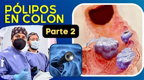 Síntomas Diagnostico y Tratamiento de los Pólipos en Colon Parte 2
