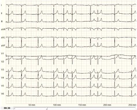 Whats The Atrial Conduction Patternrhythm Rekgs