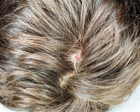 Skin Stretching Device Shows Promise For Closing Large Scalp Wounds Plastic Surgery Practice