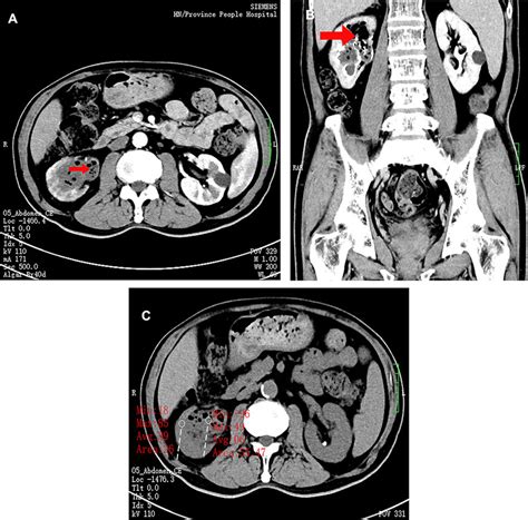 Renal Fungal Ball Ct At Frank Duke Blog