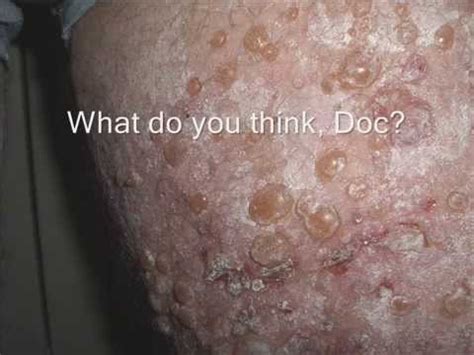 Hideous Skin Disease Bullous Pemphigoid YouTube