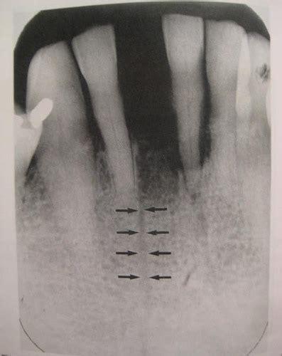 Ch 21 Normal Radiographic Anatomy Of Intraoral Structures Flashcards Quizlet