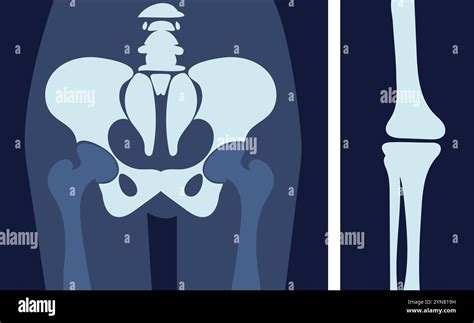 X Rays Image With Bone Xray Of Pelvis And Knee Diagnosis And