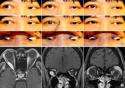 Extraocular Muscles Examination A And Orbit Magnetic Resonance Download High Resolution
