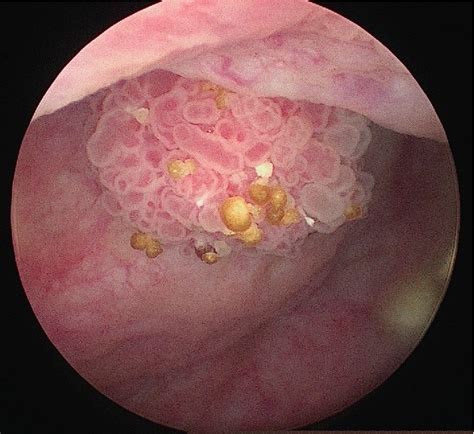 Figure 1 From The Role Of Semaphorin 6d Sema6d In Non Muscle Invasive Bladder Cancer—a