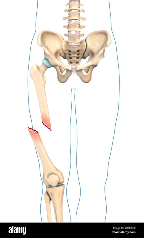 Compound Femur Fractures