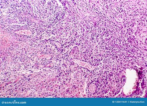 Chronic Cholecystitis Light Micrograph Stock Image 122813083