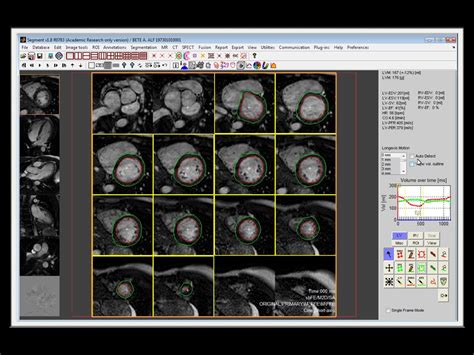 Mri Blog Segment Medical Image Analysis Software For Mac Os X